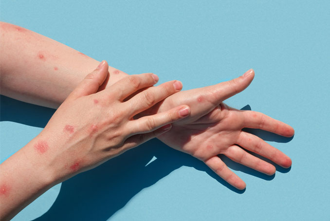 Recrudescence de la rougeole : vigilance renforcée | Agence régionale ...